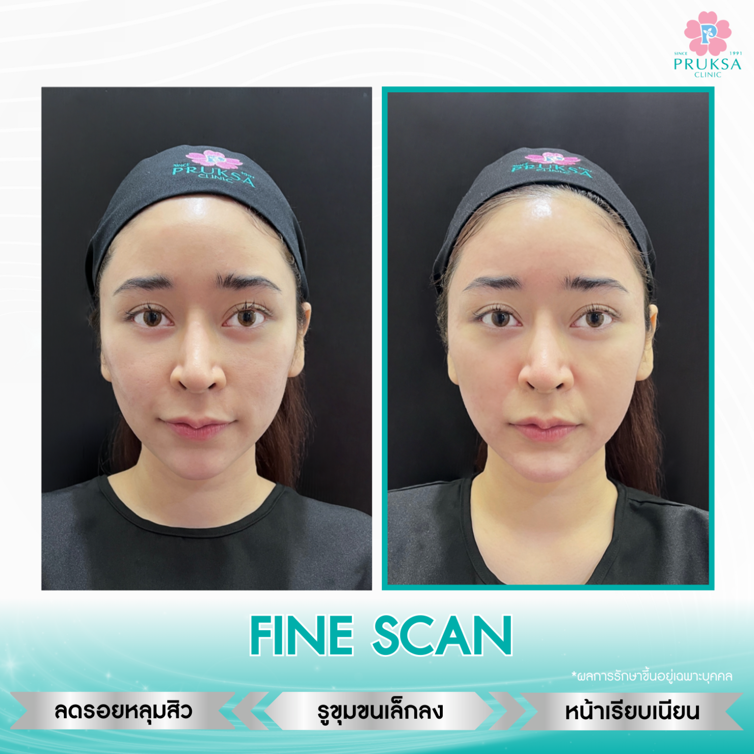 Fine Scan Laser program (โปรแกรม ไฟน์ สแกน เลเซอร์) - pruksaclinic