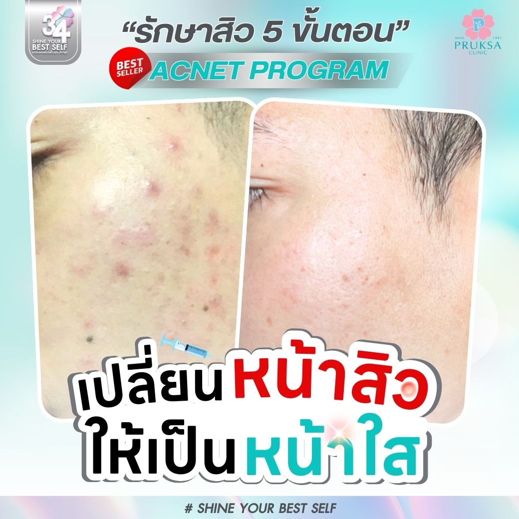 Acnet Program (แอคเนท โปรแกรม) - pruksaclinic