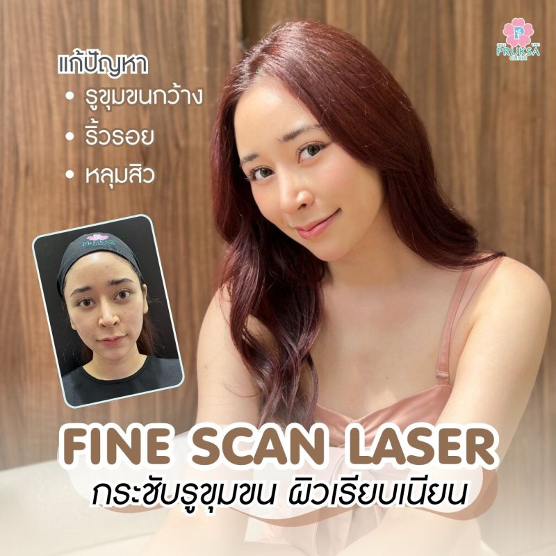 Fine Scan Laser program (โปรแกรม ไฟน์ สแกน เลเซอร์) - pruksaclinic
