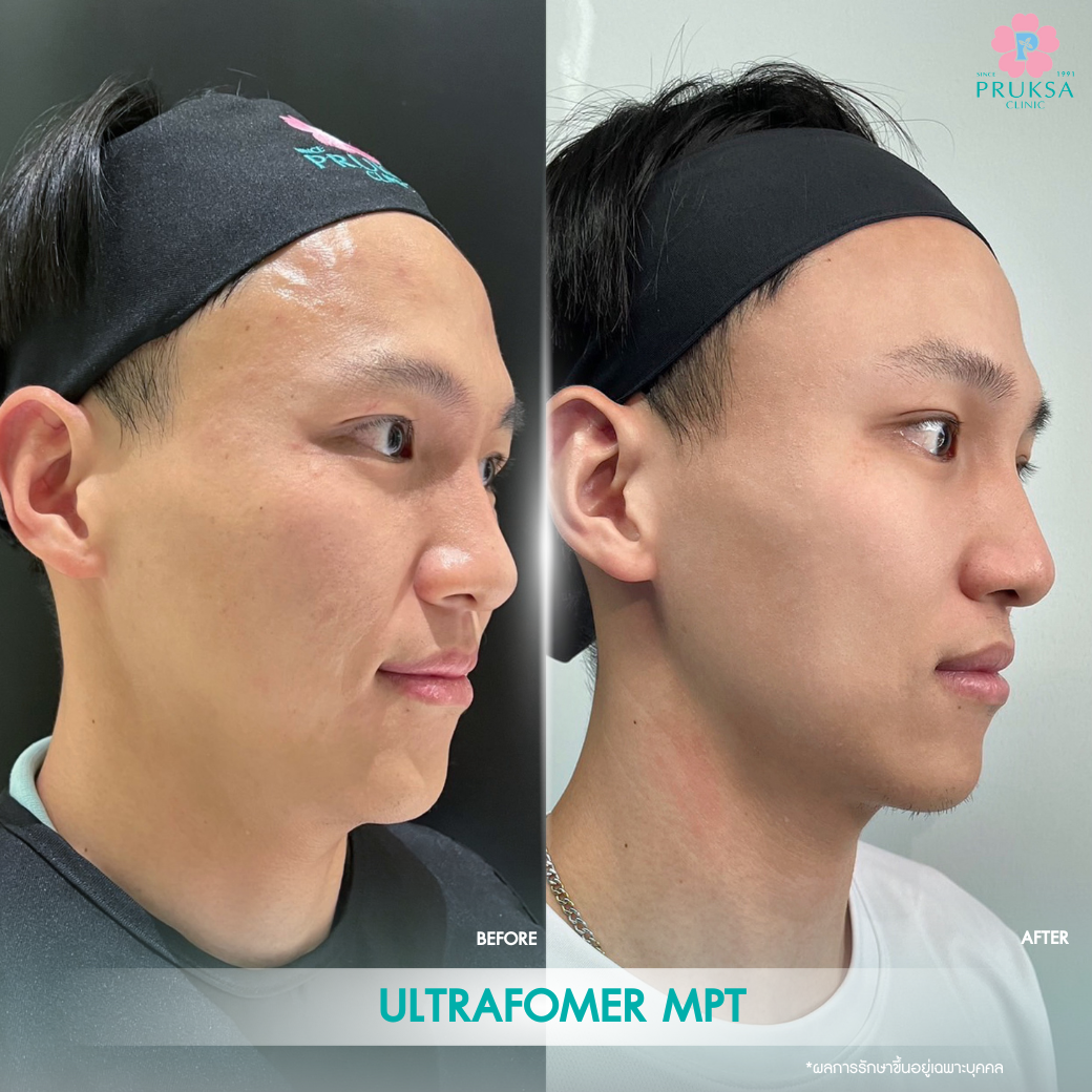 ULTRAFORMER III & ULTRAFORMER MPT - pruksaclinic