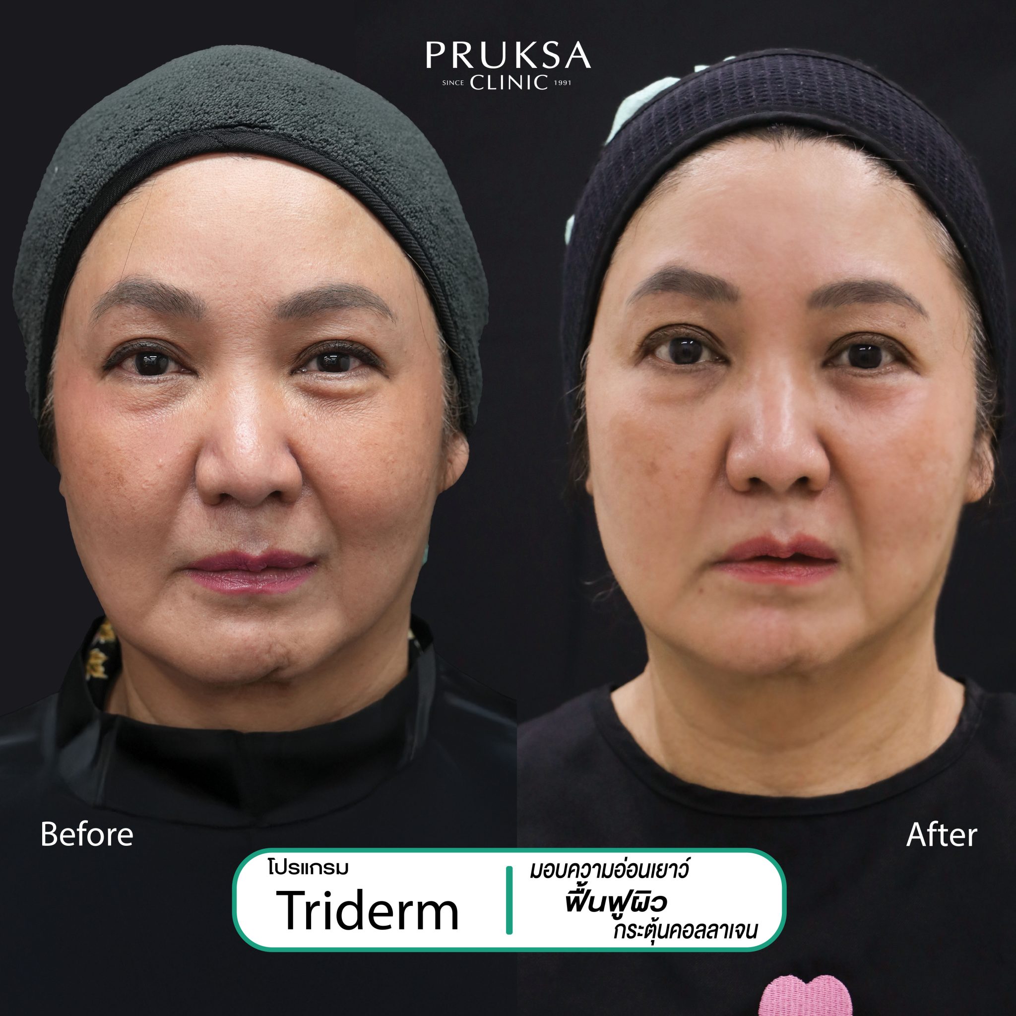 TRIDERM - pruksaclinic
